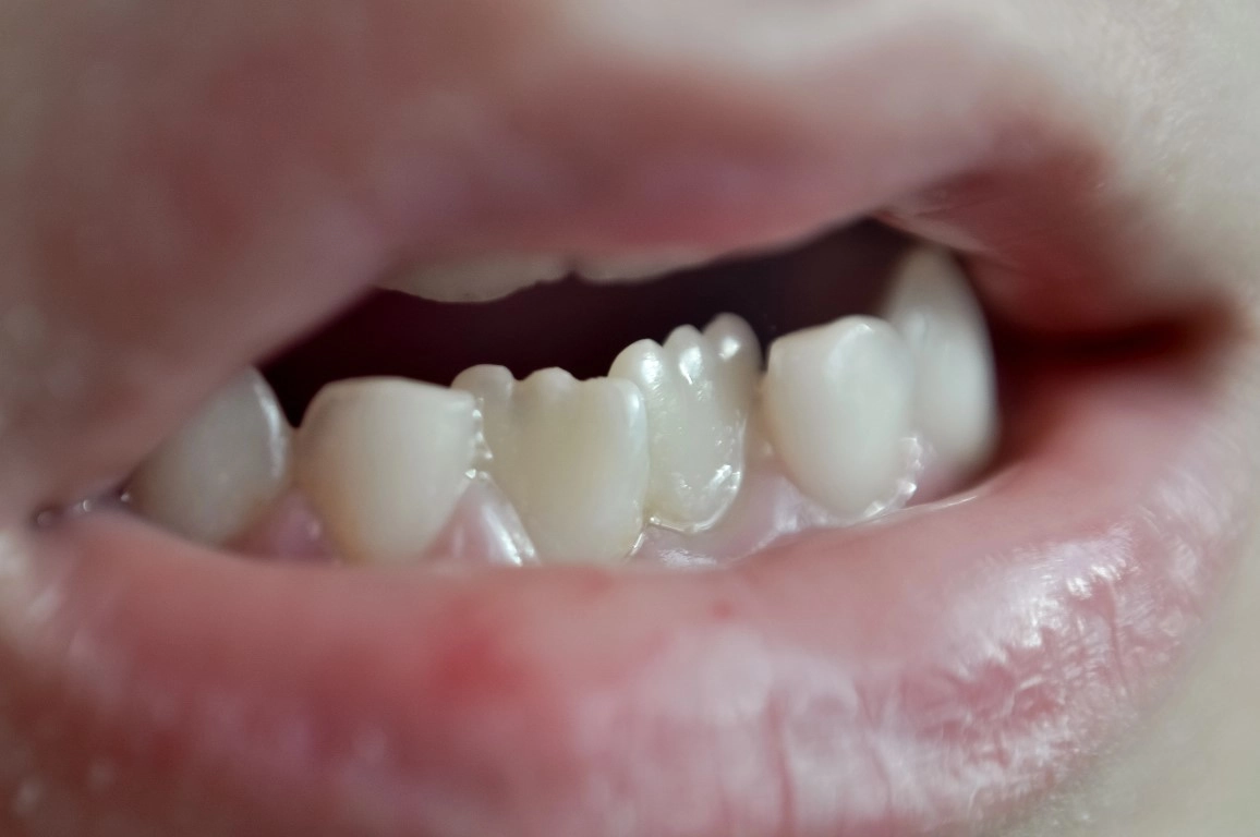 What Are Mamelons On Teeth, And Should You Be Concerned? | Eric Felt, D.D.S